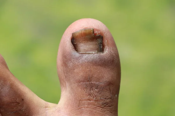 Onychocryptosis Stock Photos, Royalty Free Onychocryptosis Images ...