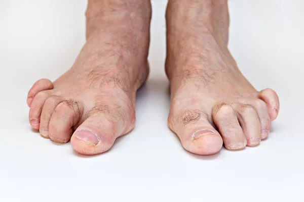 Hammer toes Stock Photos, Royalty Free Hammer toes Images | Depositphotos