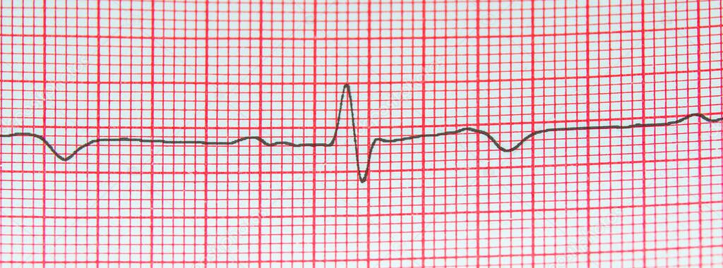 Ecg normal Stock Photos, Royalty Free Ecg normal Images | Depositphotos®
