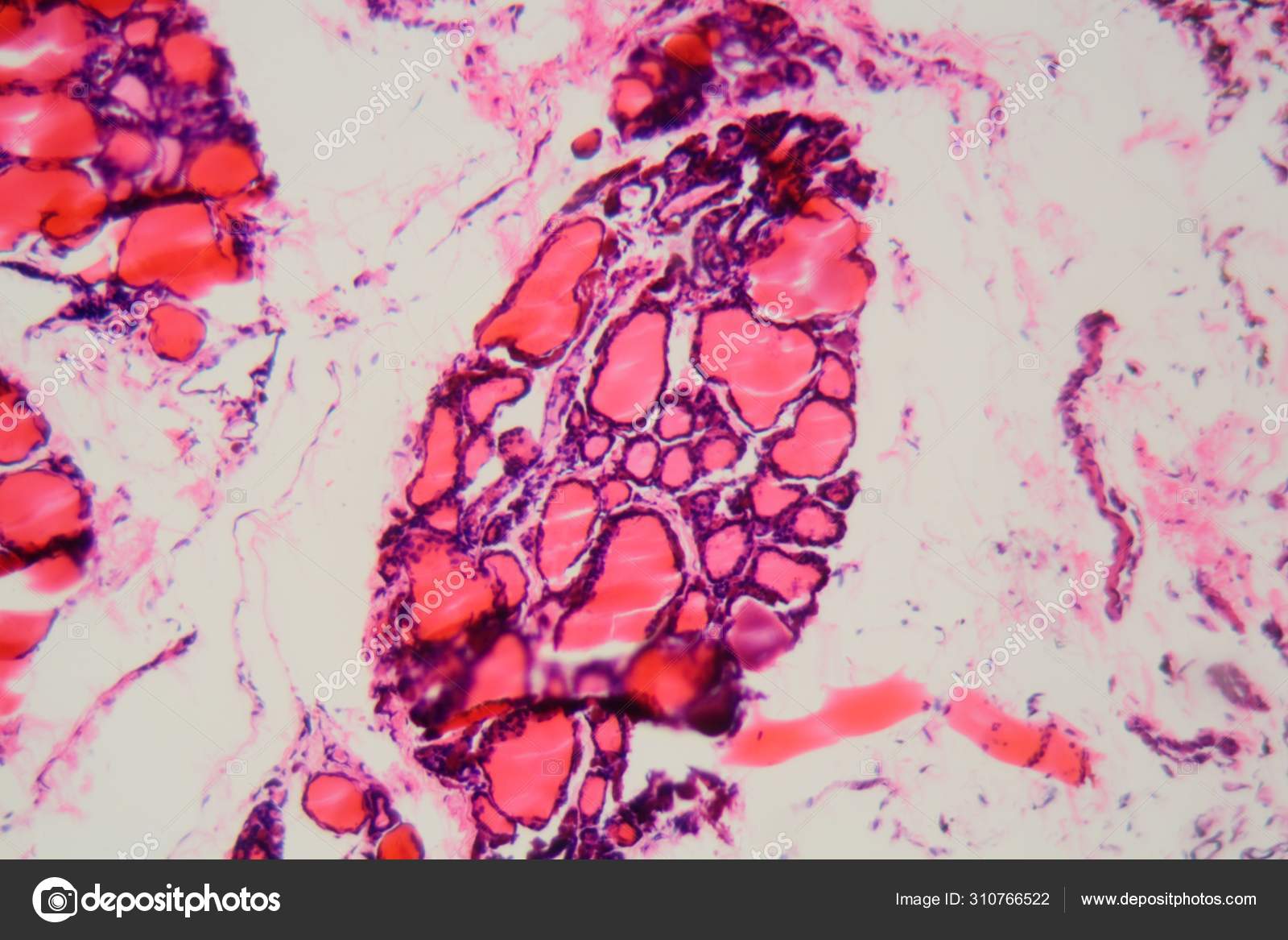 Human thyroid gland with goiter caused by deficiency of iodine under a ...