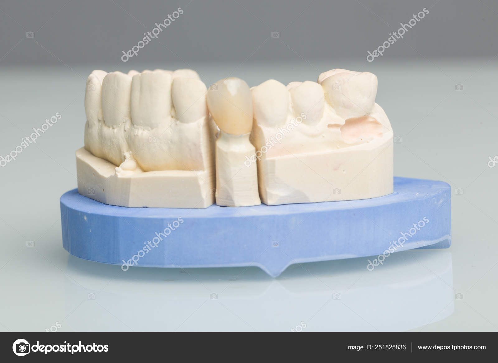 Dental Imprint Artificial Dentition Dental Laboratory Ready Use Stock ... Dental Imprint Artificial Dentition Dental Laboratory Ready Use Stock ...