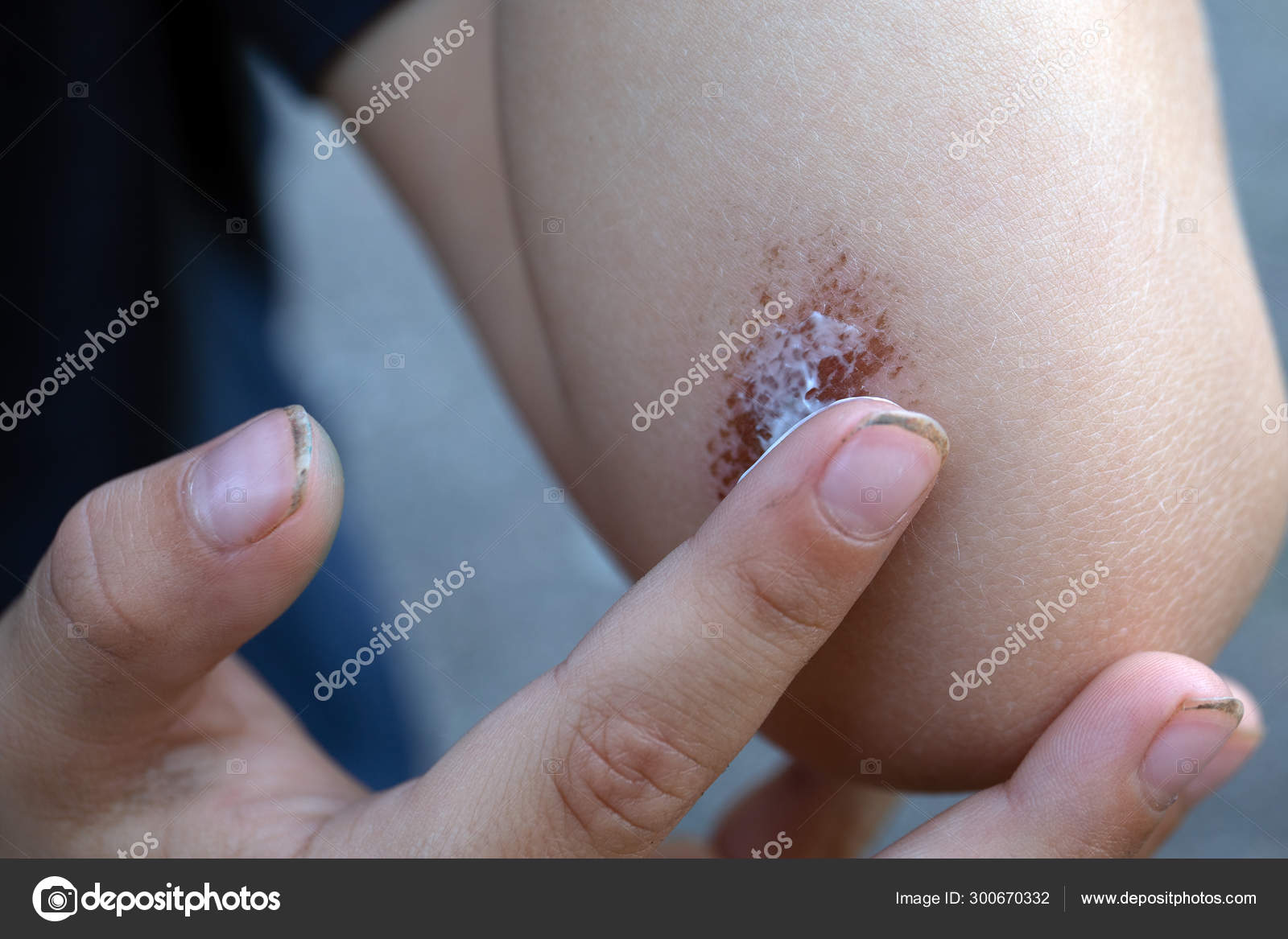 Putting salve on scratched skin on kid elbow, care of injury after ...