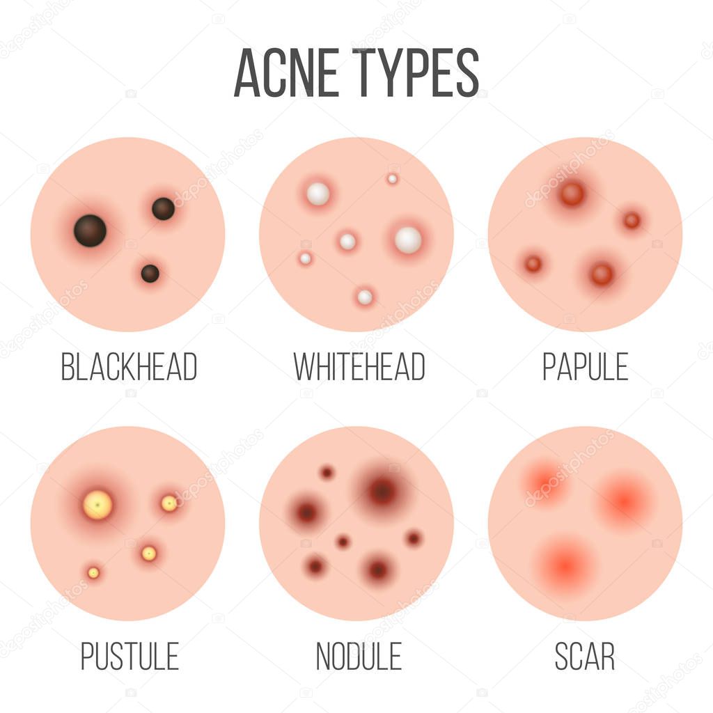 Ilustración vectorial creativa tipos de acné, granos, poros de la piel, blackhead, whitehead ...