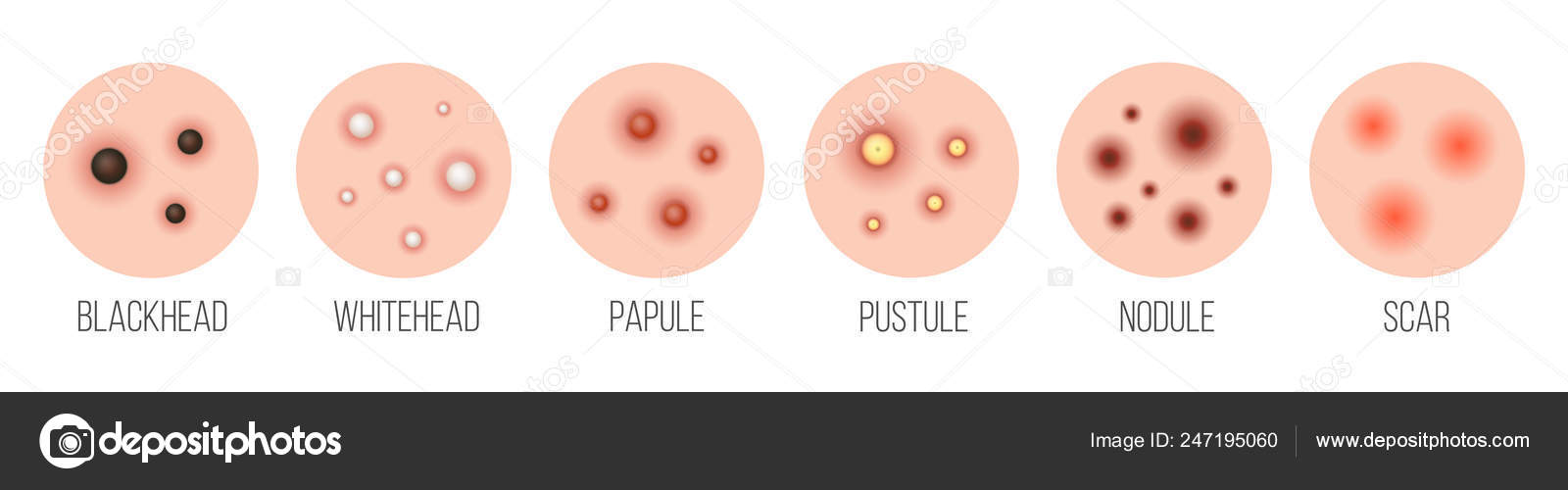 Kreative Vektorillustration Arten von Akne, Pickel, Hautporen, Mitesser ...