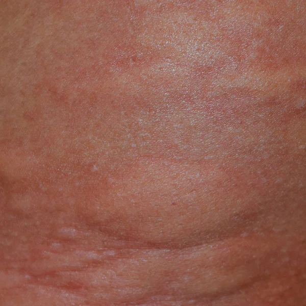 Syndrome inflammatoire Stock Photos, Royalty Free Syndrome ...