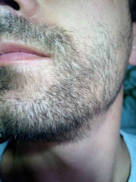 Rash on beard Stock Photos, Royalty Free Rash on beard Images ...