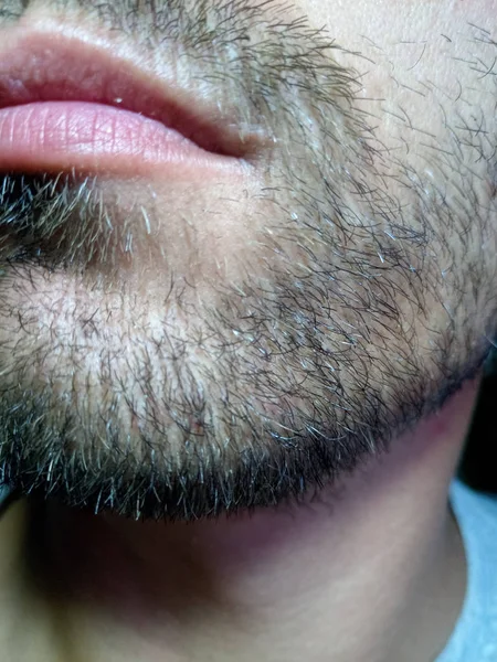Rash on beard Stock Photos, Royalty Free Rash on beard Images ...