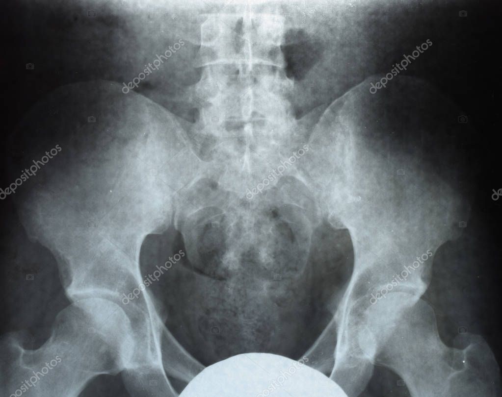Radiografía de la pelvis y el sacro. Radiografía 2022