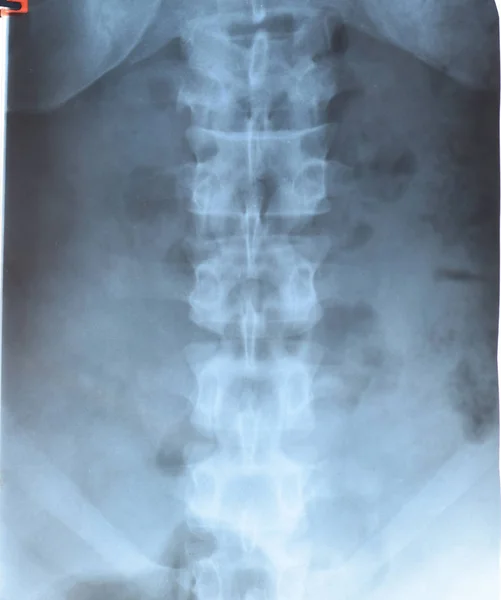 Curved spine xray Stock Photos, Royalty Free Curved spine xray Images ...