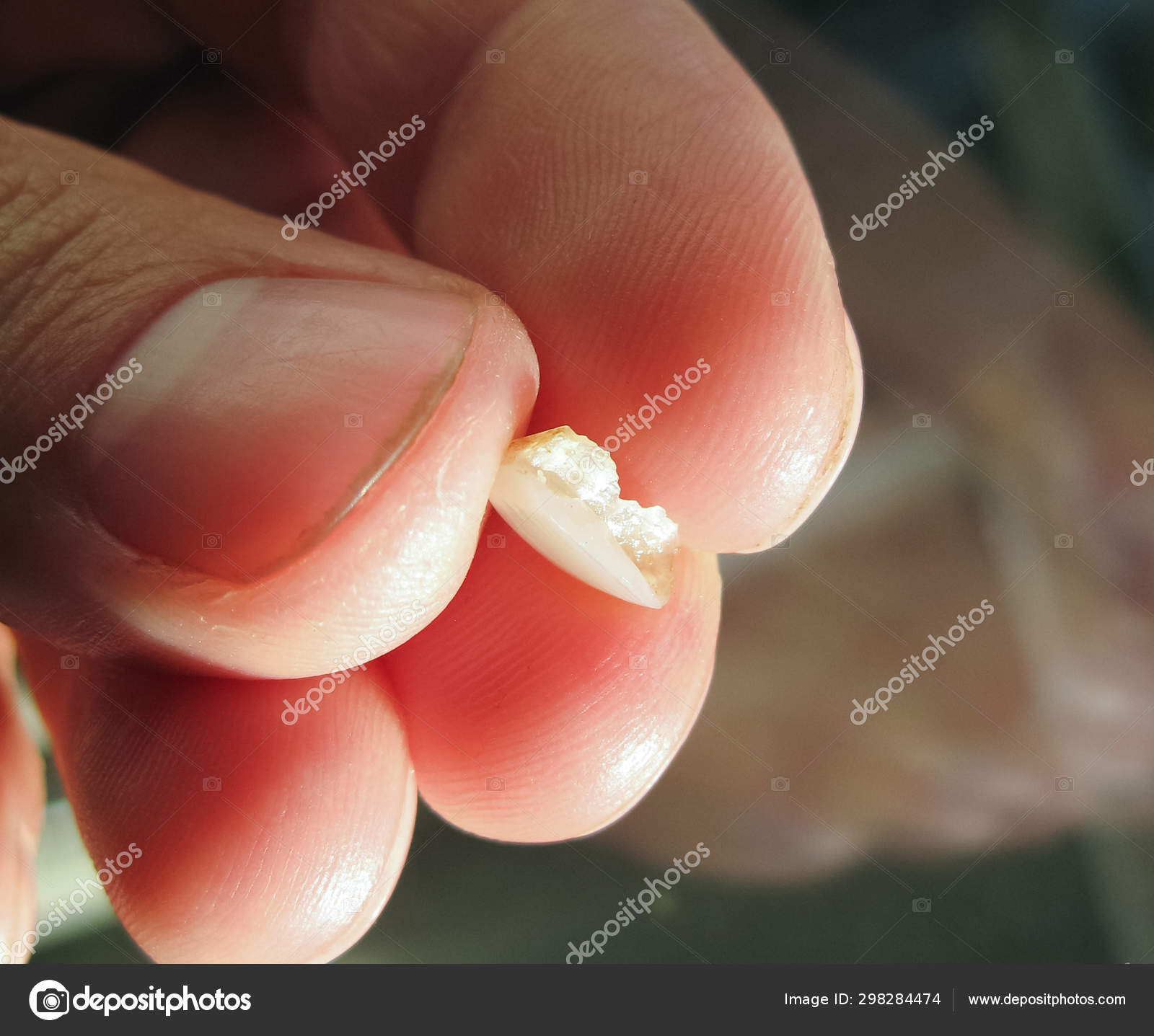 Fallen off old filling with a cutter. The seal of the tooth. — Stock ...