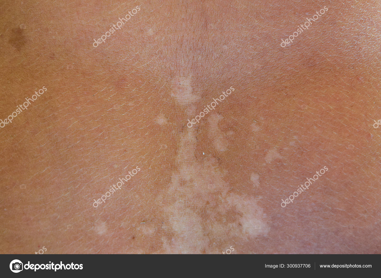 Sunburn on the skin of the back. Exfoliation, skin peels off. Dangerous ...