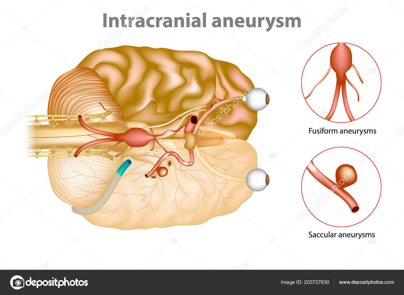 Intracranial Aneurysm Brain Aneurysm Stock Vector by ©Sakurra 203727630 Intracranial Aneurysm Brain Aneurysm Stock Vector by ©Sakurra 203727630
