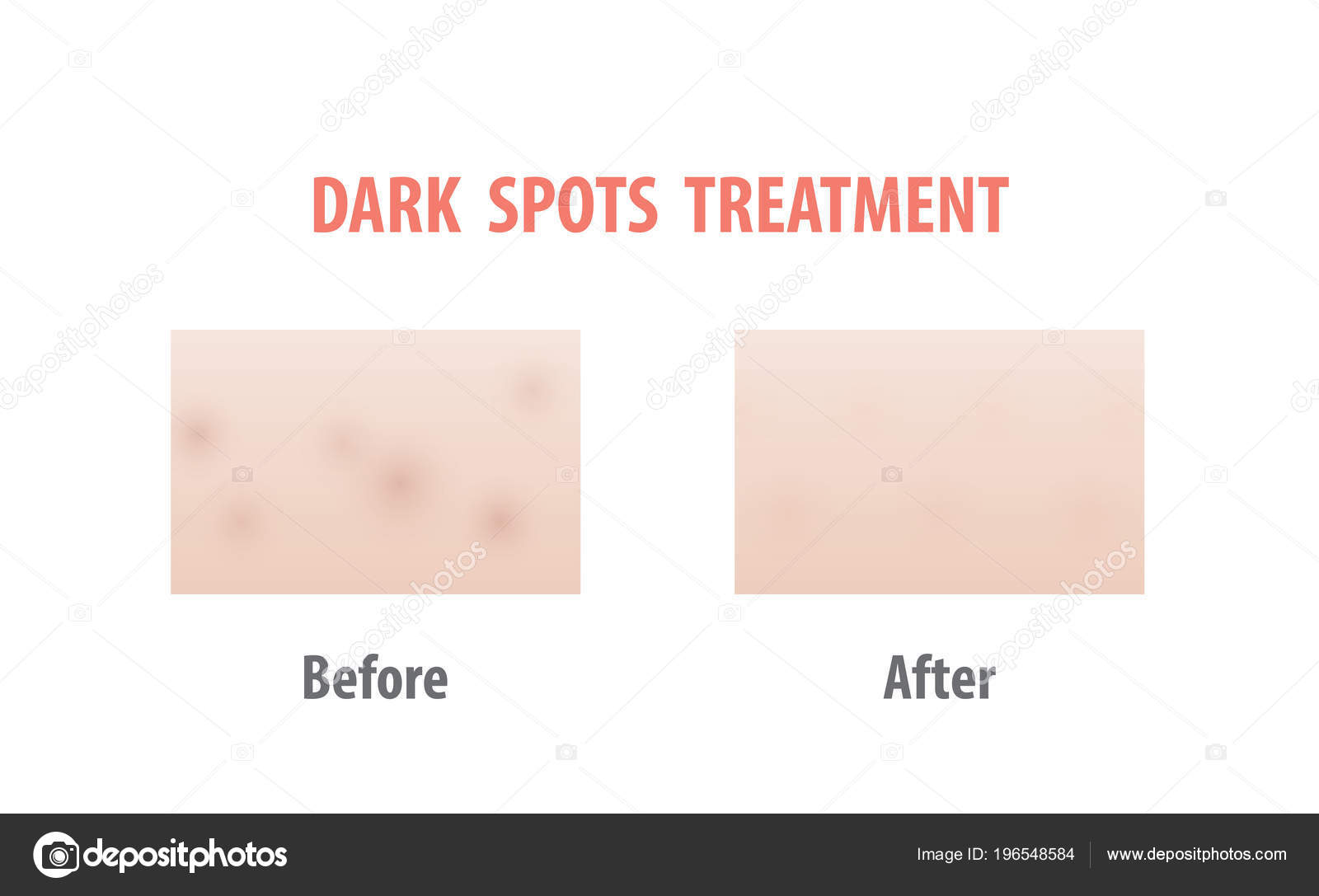 Dark Spots Treatment Comparison Illustration Vector White Background ...