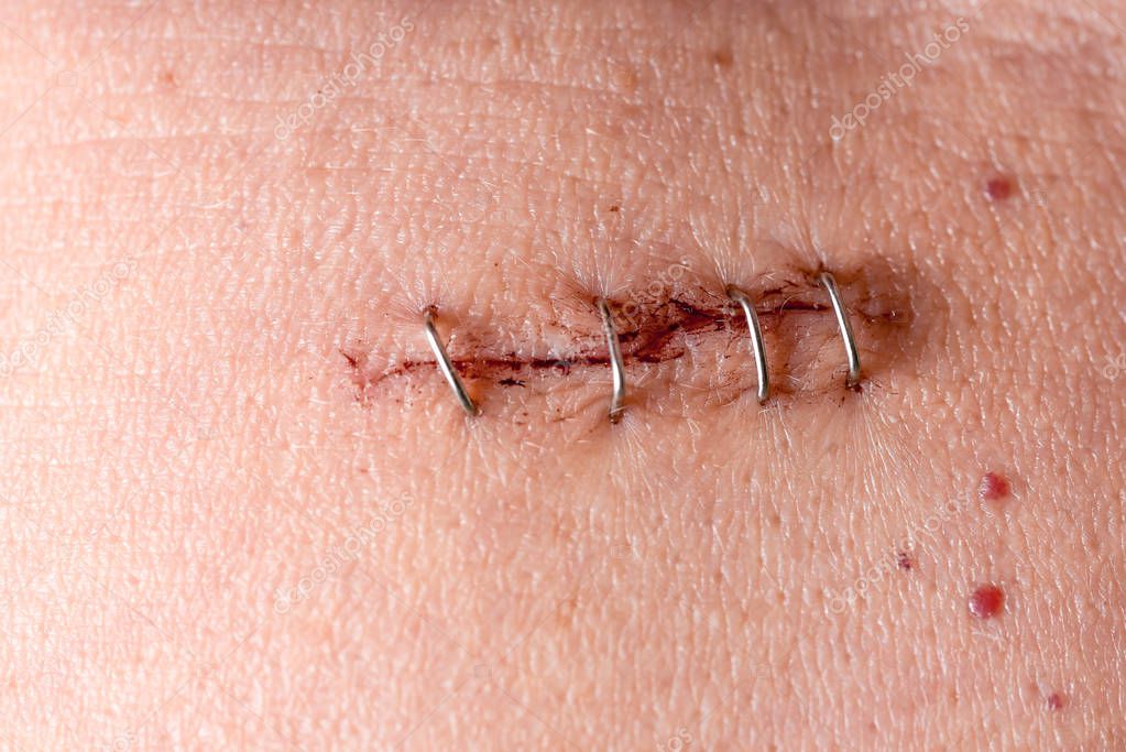 grapas metálicas (tallas) en una cicatriz dejada por una laparoscopia 2022