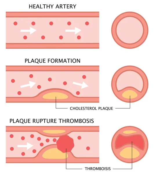 Atherosclerosis. Fibrous plaque formation in the artery — Stock Vector ...