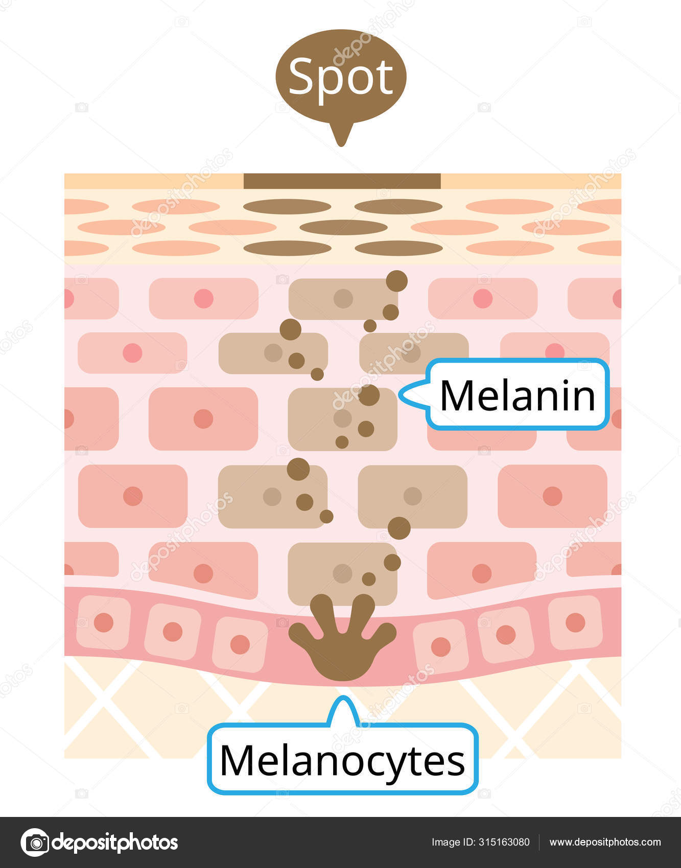 Human Skin Layer Melanin Facial Dark Spots Infographic Skin Layer Stock ...