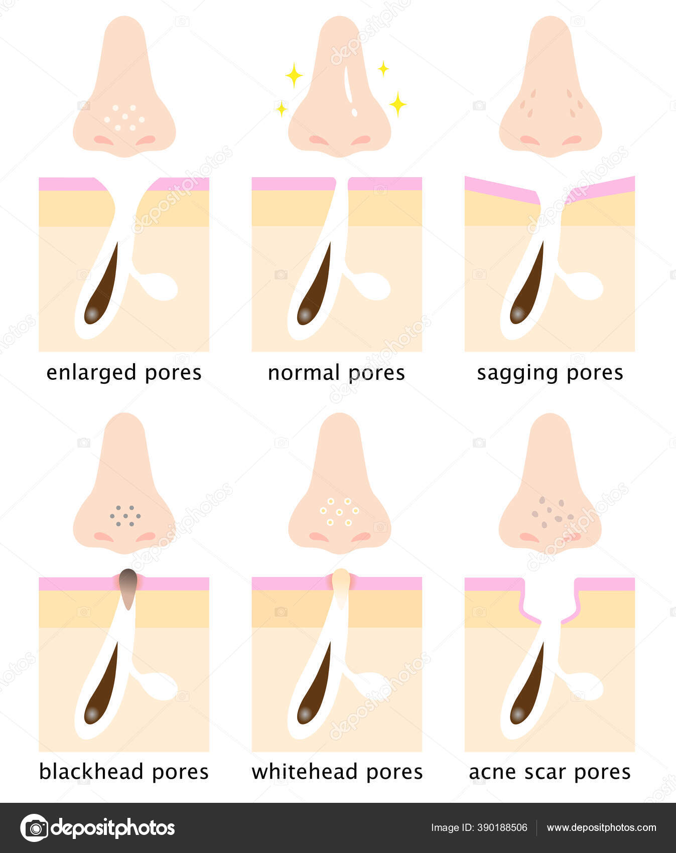 Blackhead Diagram