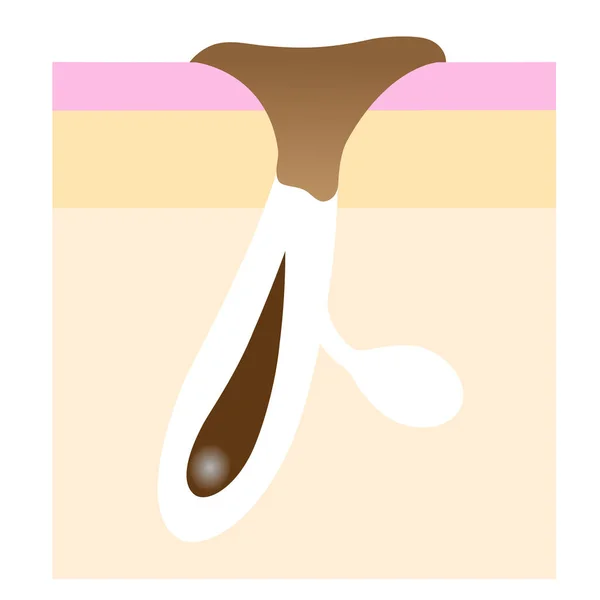 Cartoon illustration of clogged pores and clean pores on nose Stock ...