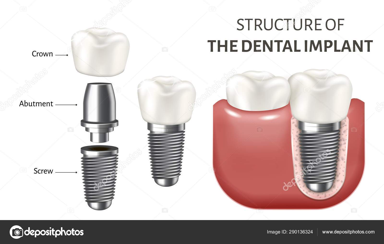 Medical vector illustration showing a structure of the dental implant ...