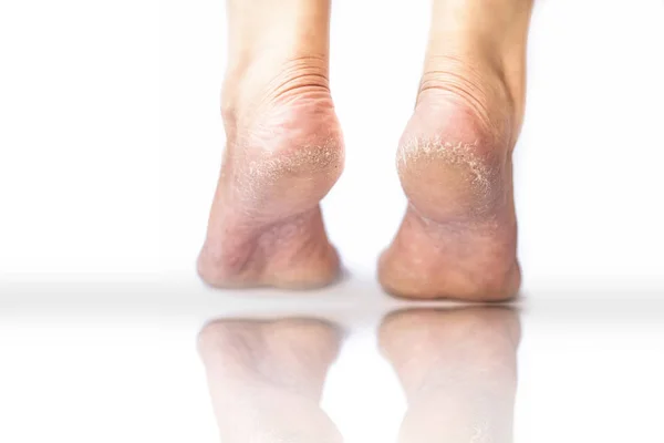 Dry feet Stock Photos, Royalty Free Dry feet Images | Depositphotos