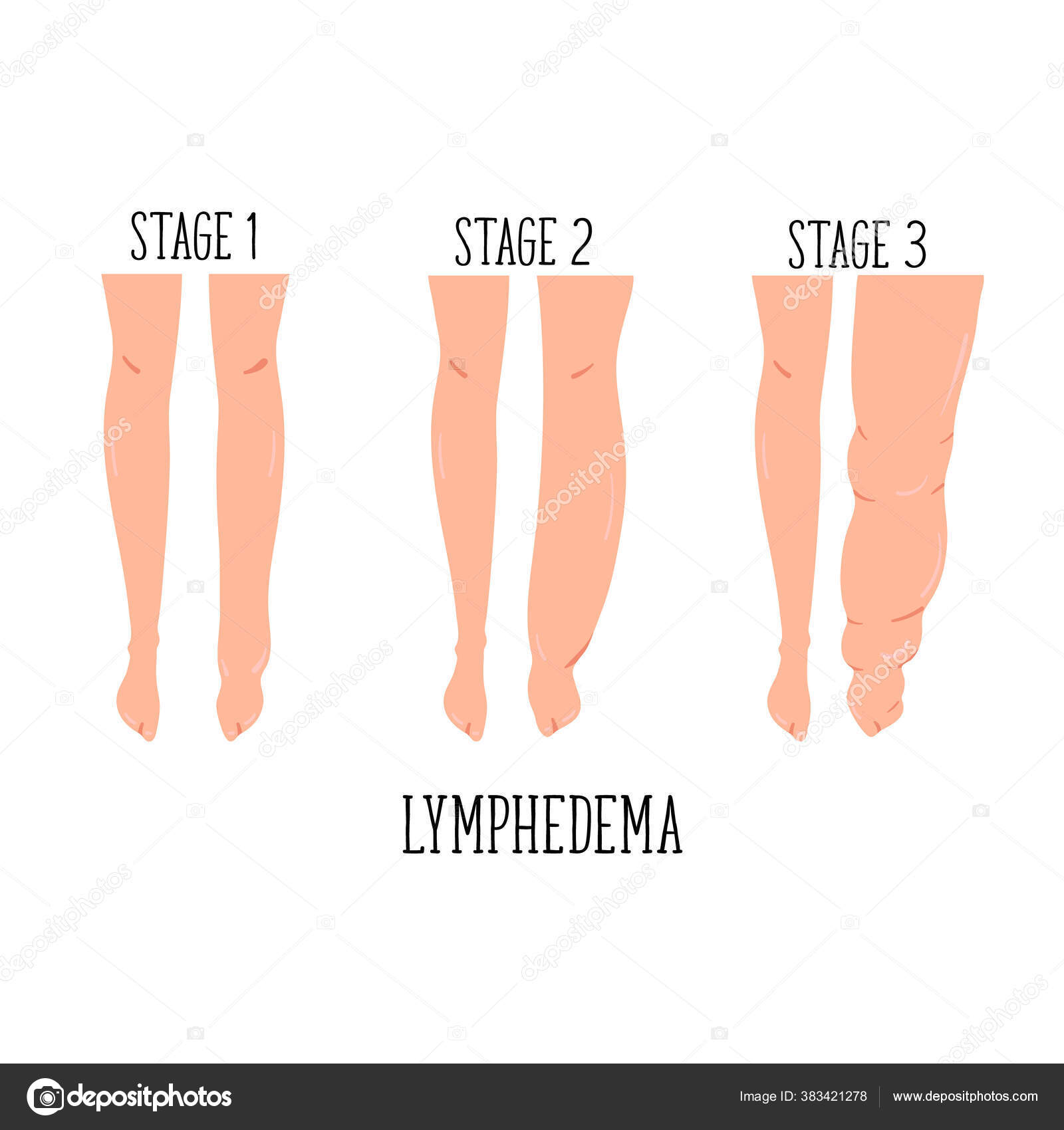Elephantiasis Diagram