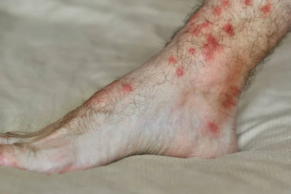 Flat Red Spots On Feet