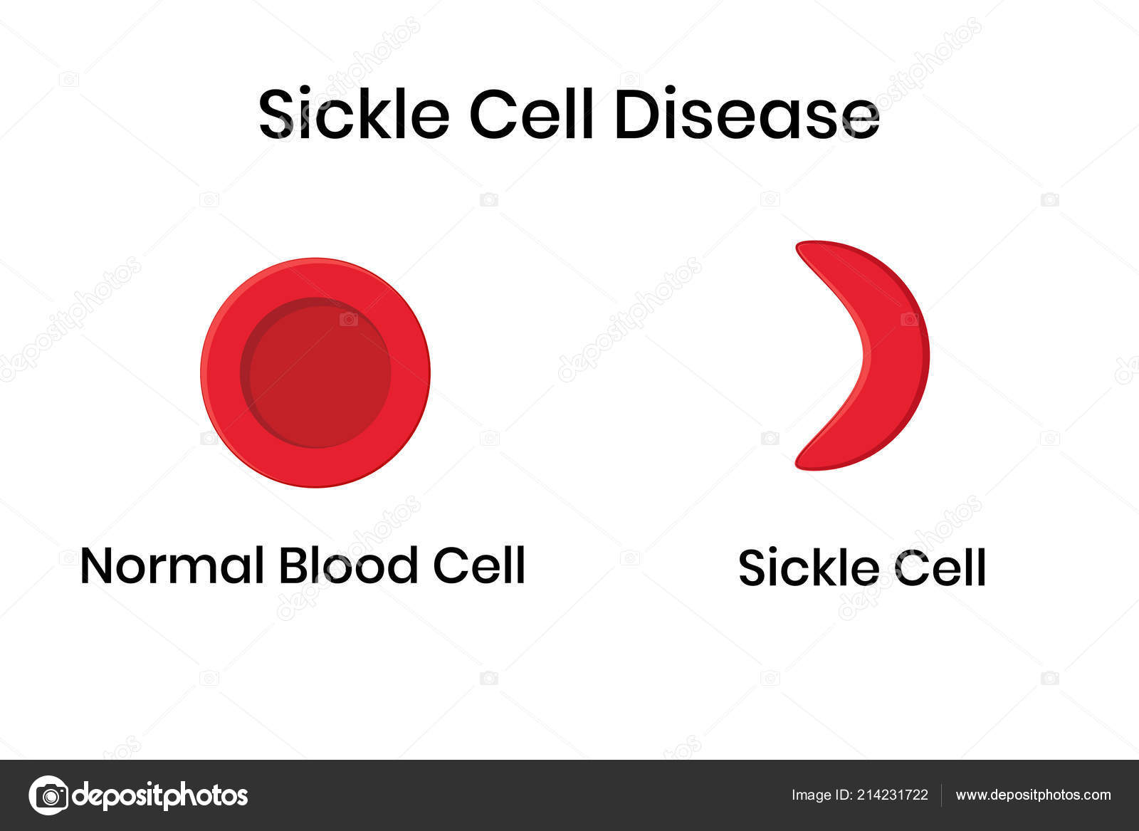 Sickle Cell Anemia Normal Erythrocyte Distorted Sickle Cell Stock ...