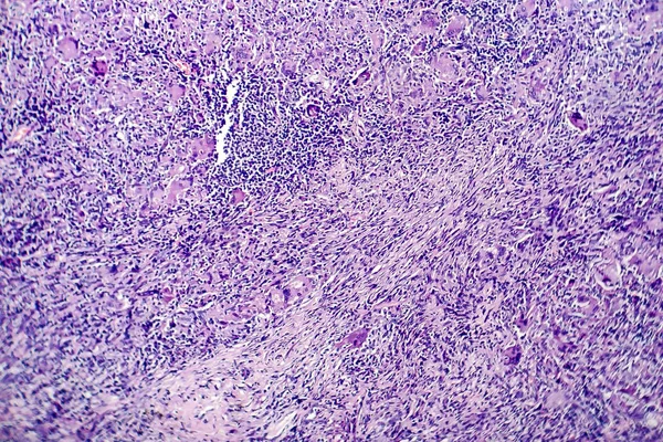 Histopathology of biliary cirrhosis Stock Photo by ©katerynakon 288889846