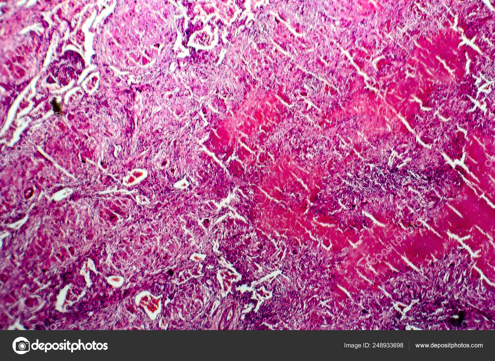 Tuberculosis miliar, micrografía ligera: fotografía de stock ...