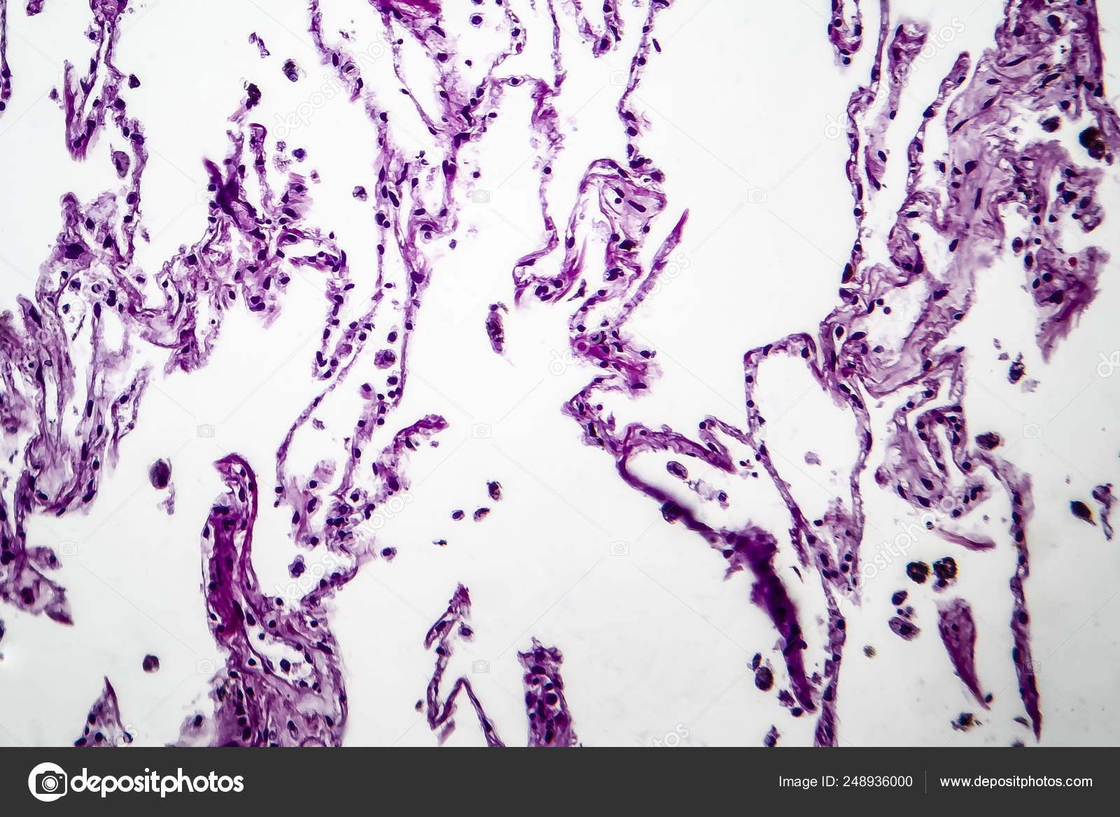 Enfisema pulmonar, micrografia de luz fotos, imagens de © katerynakon ...