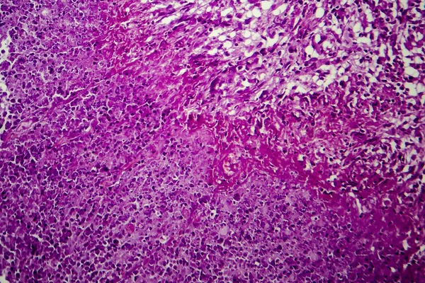 Caseation del granuloma de la tuberculosis humana, micrográfo ligero ...