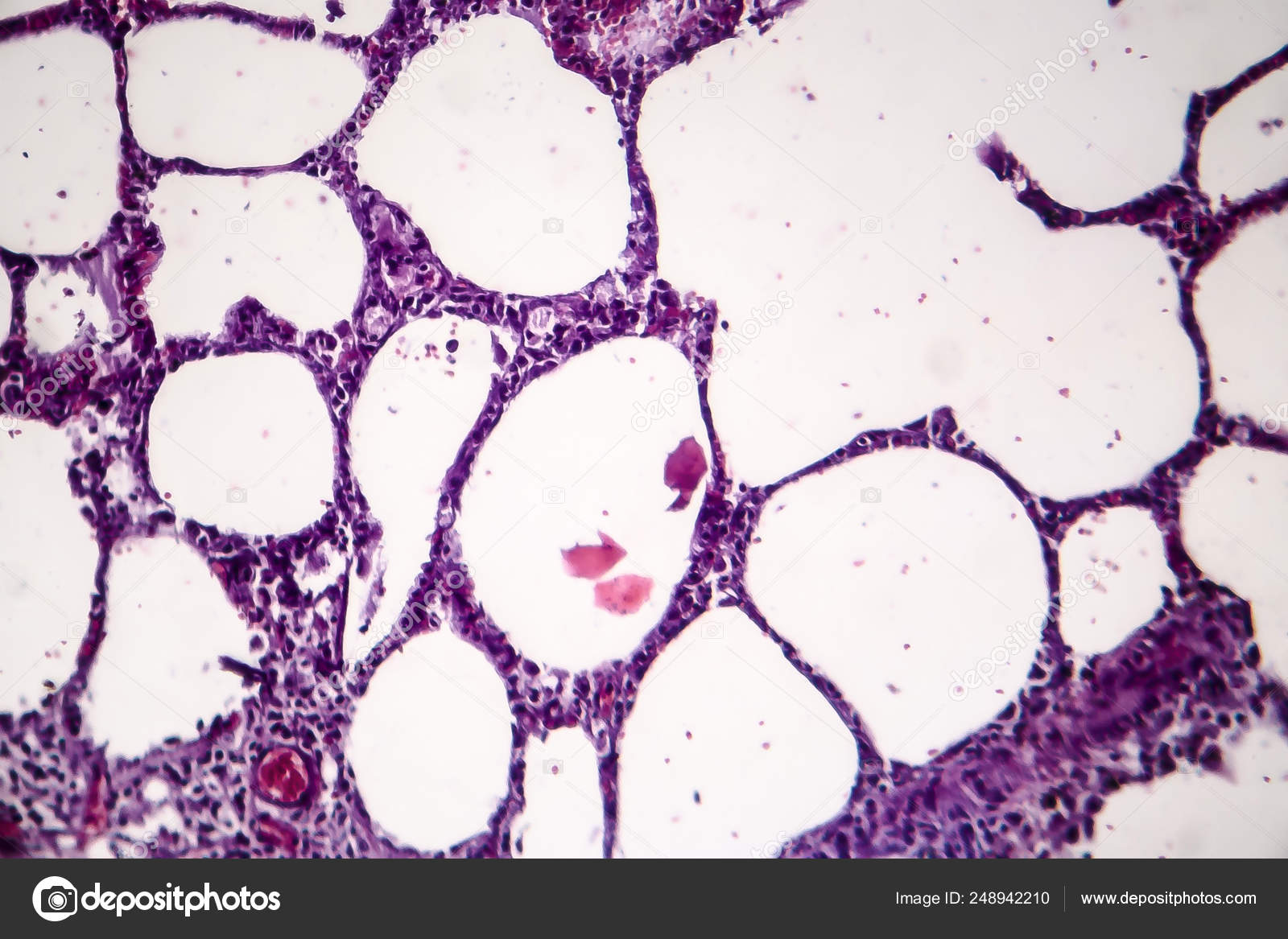 Pneumonia, light micrograph Stock Photo by ©katerynakon 248942210