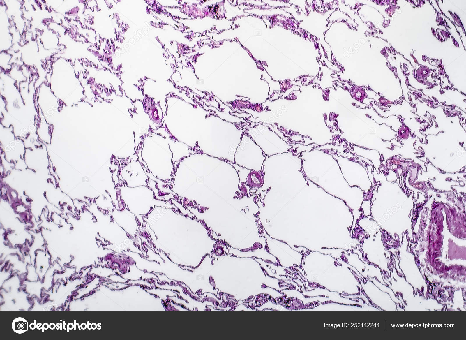 Lung emphysema, light micrograph Stock Photo by ©katerynakon 252112244