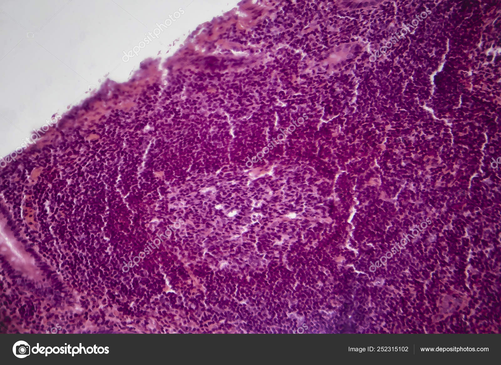 Acute simple appendicitis, light micrograph Stock Photo by ©katerynakon ...