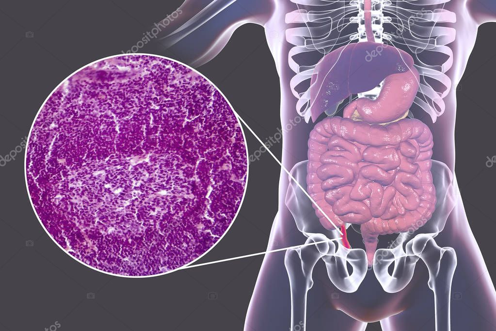 Apendicitis aguda, ilustración y micrografía ligera 2023