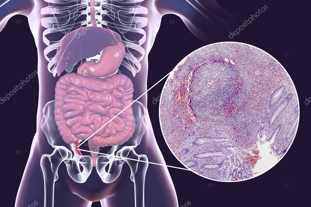 Apendicitis crónica, ilustración y micrografía ligera 2023