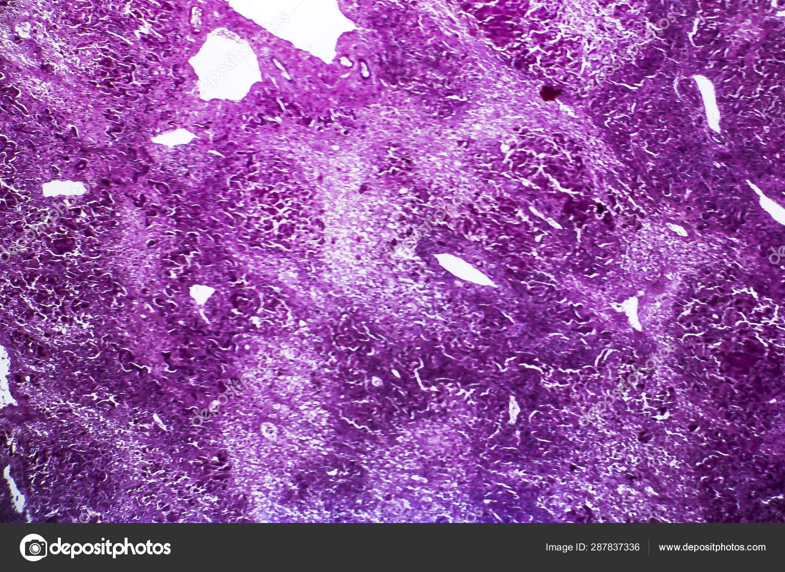 Subacute severe hepatitis, light micrograph Stock Photo by ©katerynakon ... Subacute severe hepatitis, light micrograph Stock Photo by ©katerynakon ...