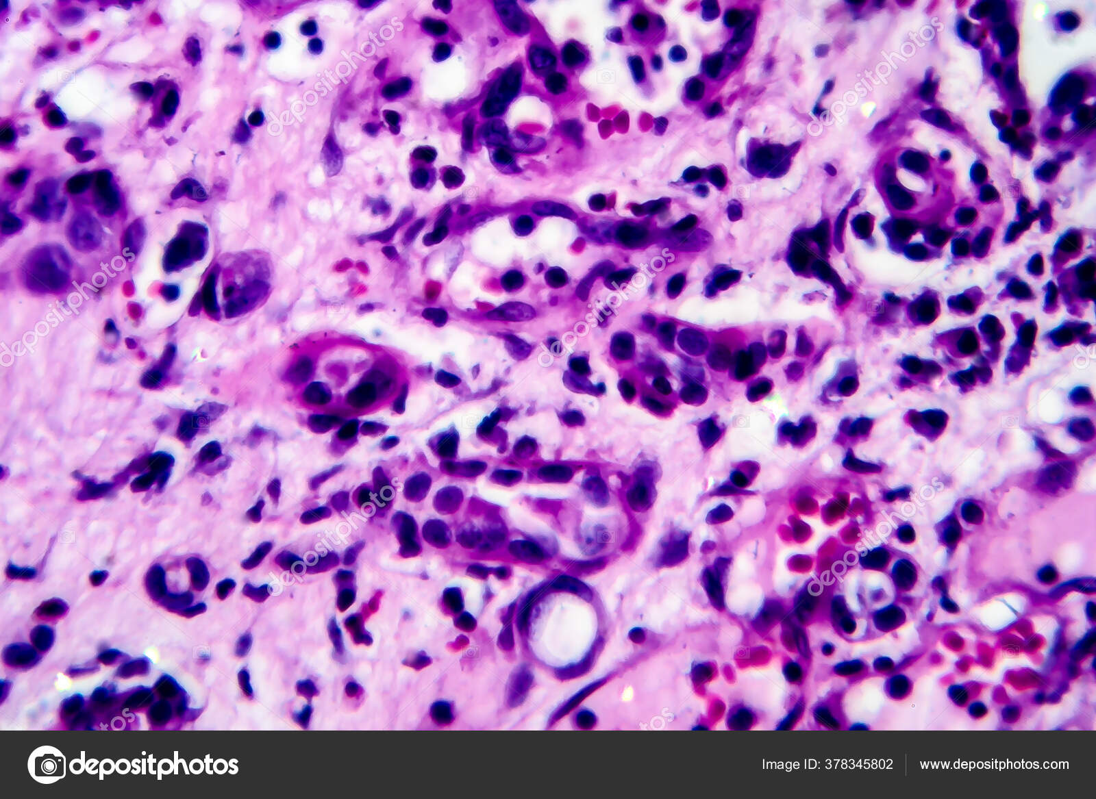 Histopathology Interstitial Nephritis Light Micrograph Photo Microscope ...