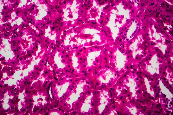 Colon cancer, light micrograph Stock Photo by ©katerynakon 287825294