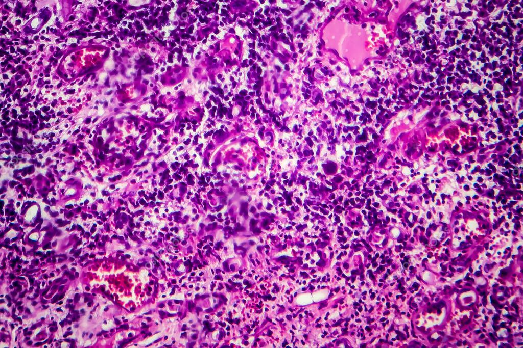 Histopatolog a de la nefrotis intersticial, micrograf a ligera ...