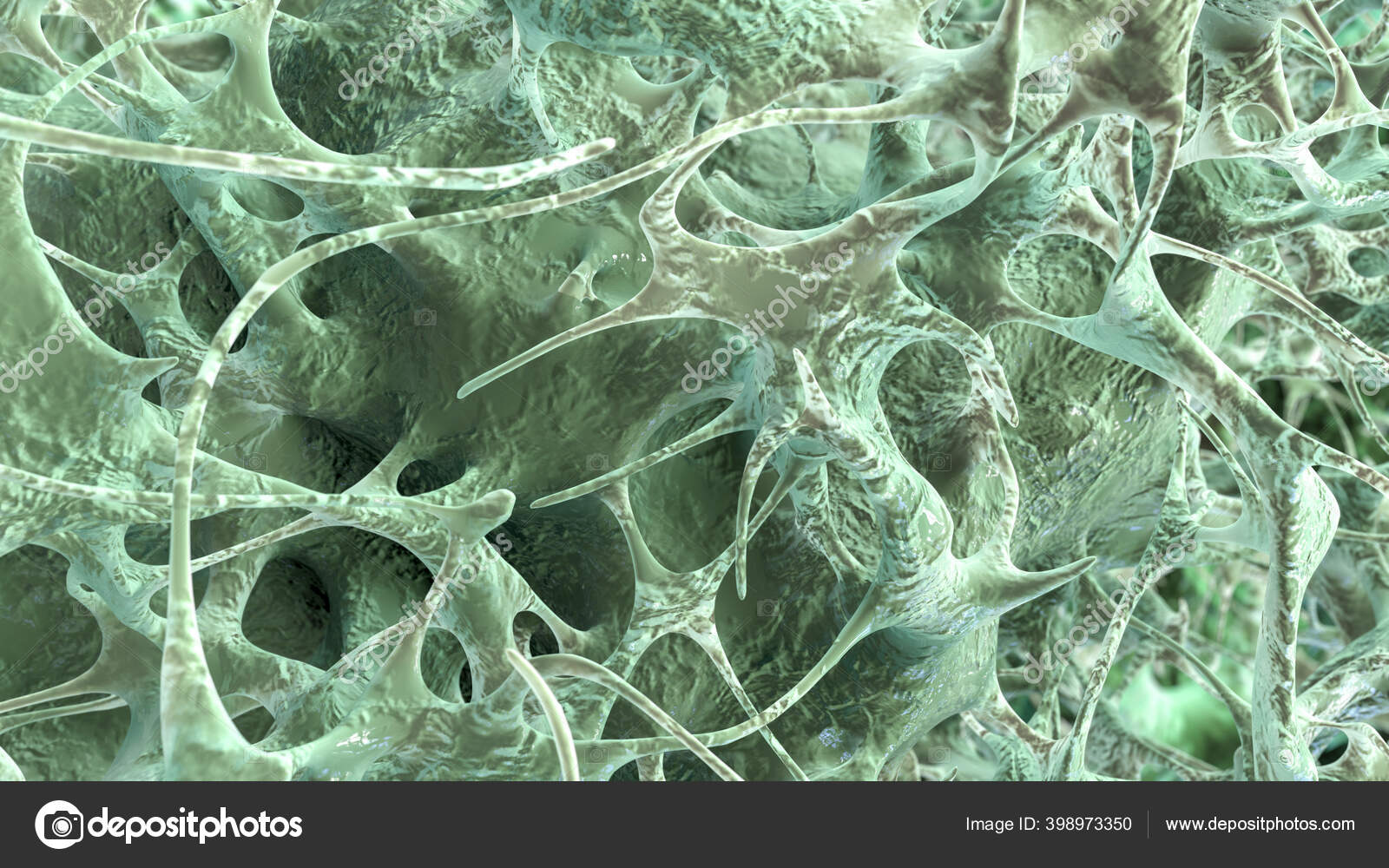 Osteoporotic Trabecular Bone Illustration Showing Fewer Thinner ...