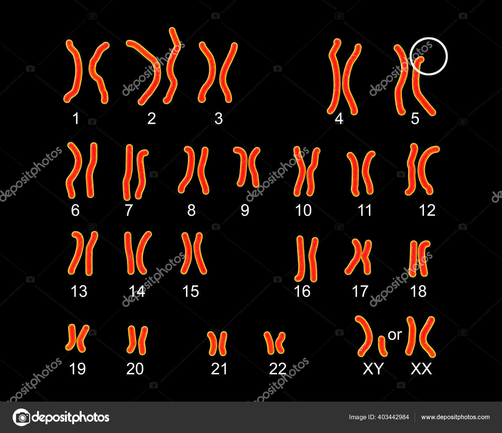 Karyotype Cri Chat Cat's Cry Syndrome Labelled Illustration Rare ...