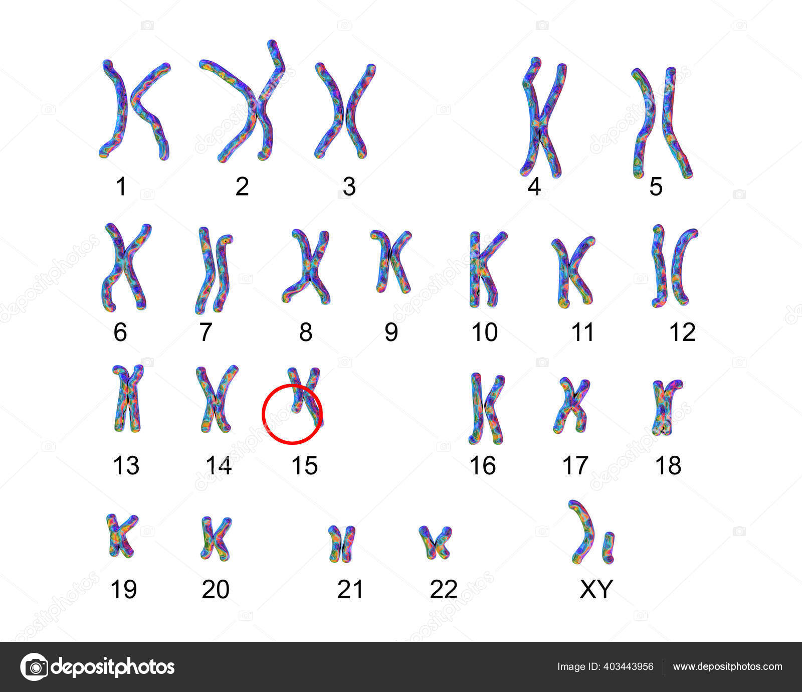 Karyotype Angelman Syndrome Labelled Illustration Genetic Disorder ...
