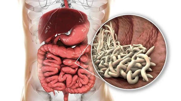 Vermes Parasitas Intestino Delgado Humano Ilustração Ascaris ...