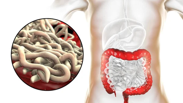 Gusanos Parásitos Intestino Delgado Humano Ilustración Ascaris ...