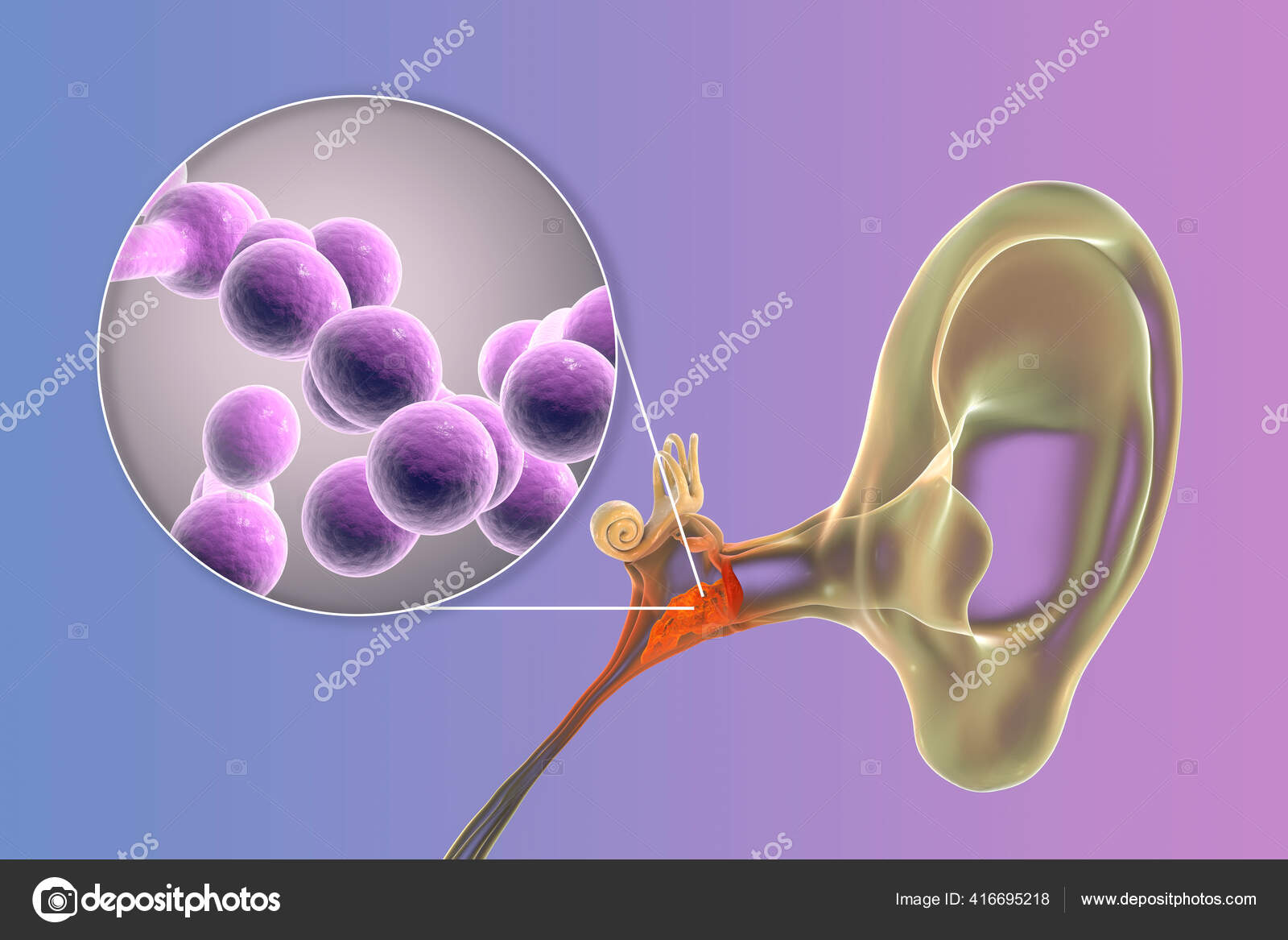 Chronic Suppurative Otitis Media Caused Fungi Candida Inflammatory ...