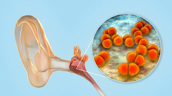 Otitis Media Caused Bacteria Staphylococcus Aureus Inflammatory Disease ...