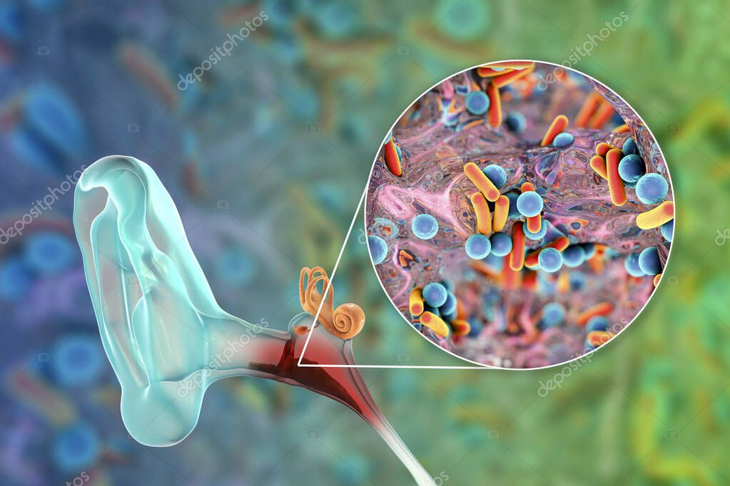 Otitis media, una enfermedad inflamatoria del oído medio, y vista de ...