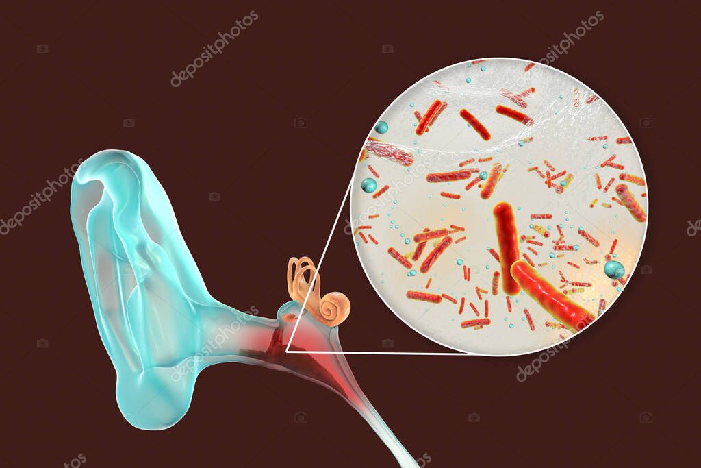 Otitis media, una enfermedad inflamatoria del oído medio, y vista de ...