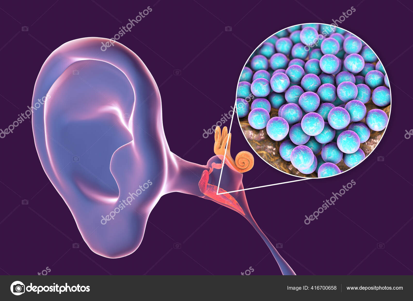 Otitis Media Caused Bacteria Staphylococcus Aureus Inflammatory Disease ...